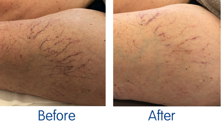 Thread Vein Removal - Harborough Laser Clinic