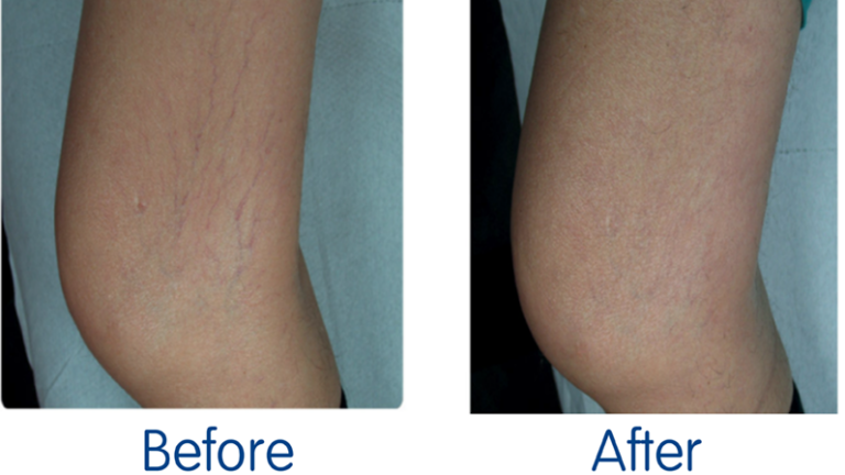 Thread Vein Removal - Harborough Laser Clinic